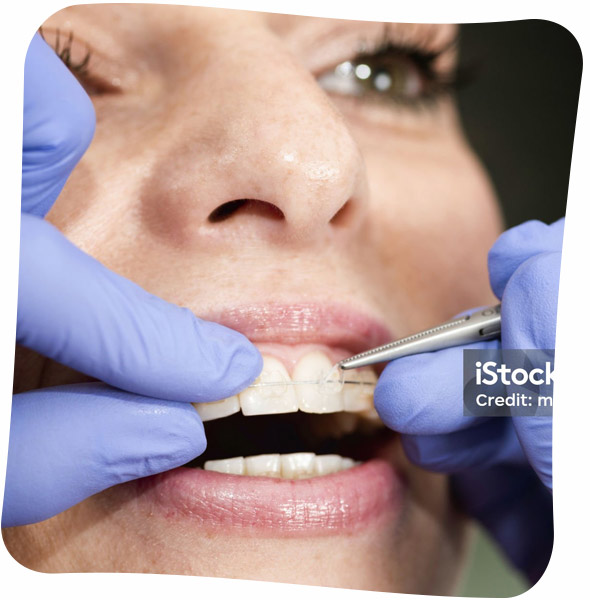 Ceramic Braces | Cumberland Dental | Tooth Coloured Braces