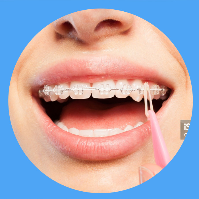 Ceramic Braces Cumberland Dental Tooth Coloured Braces