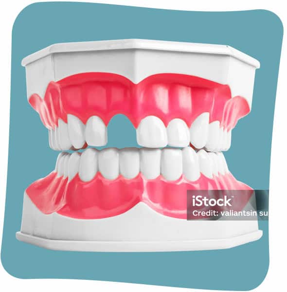 Options for Missing Teeth | Cumberland Dental Treatments