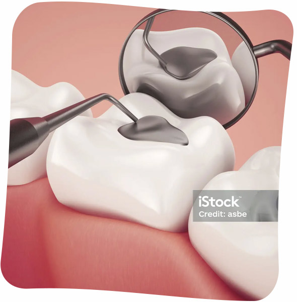 Tooth Fillings in Adelaide | Cumberland Dental