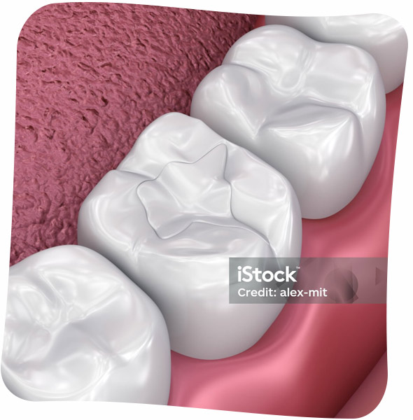 Tooth Fillings in Adelaide | Cumberland Dental | Affordable Treatments
